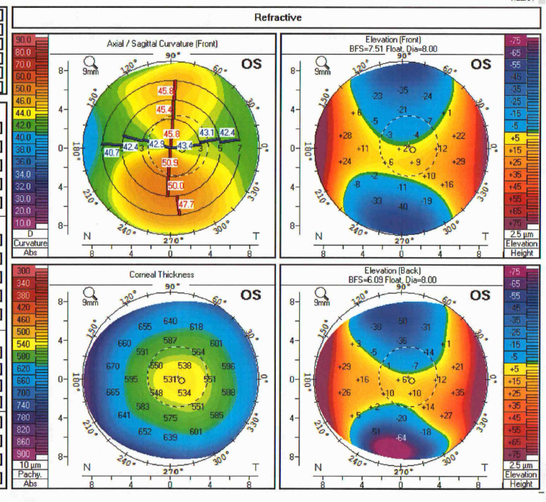 How Do I Correct Regular and Irregular Astigmatism? | Manhattan Eye