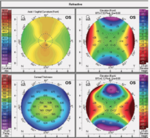 How Do I Correct Regular and Irregular Astigmatism? | Manhattan Eye
