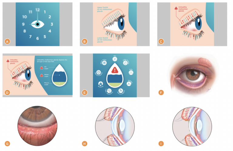 What Is TearCare & How Do Dry Eye Patients Benefit? | Manhattan Eye