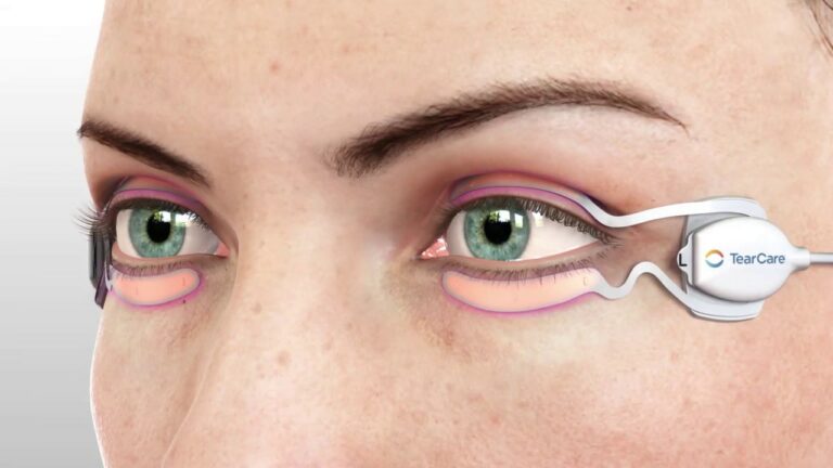 What Is TearCare & How Do Dry Eye Patients Benefit? | Manhattan Eye