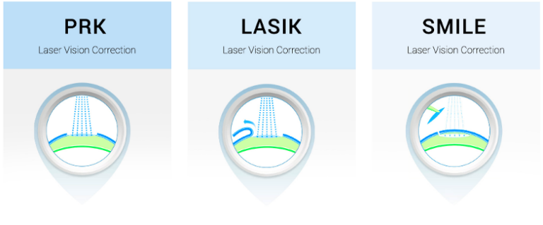 How Safe is SMILE Laser Eye Surgery? A Comprehensive Look at the Safety ...